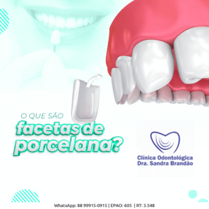 O que são facetas de porcelana? – Clínica Odontológica Dra. Sandra Brandão