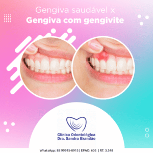 Gengiva Saudável x Gengiva com Gengivite – Clínica Odontológica Dra ...